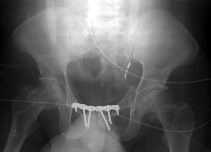 Bekken fractuur – Heelkunde Protocollen