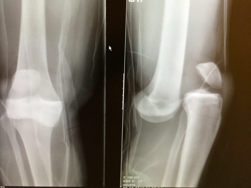 Knie luxatie – Heelkunde Protocollen