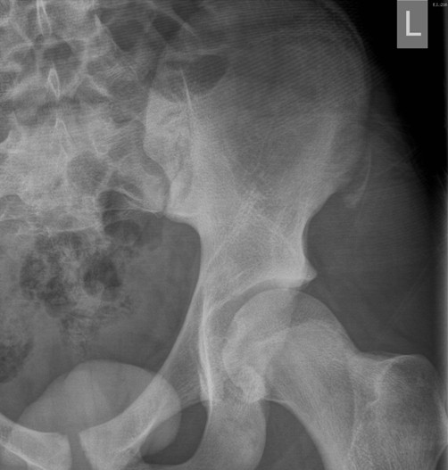 Bekken fractuur – Heelkunde Protocollen